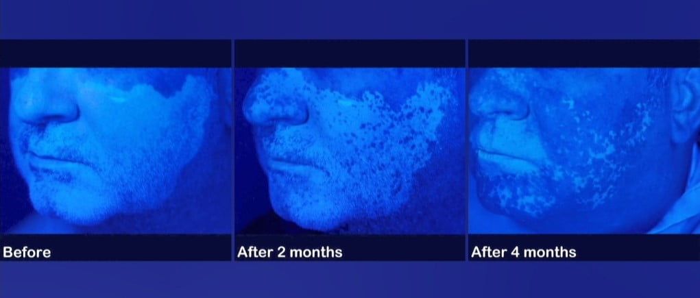 Vitiligo Expert - Ψυχοδερματολογικό Κέντρο Αντιμετώπισης της Λεύκης